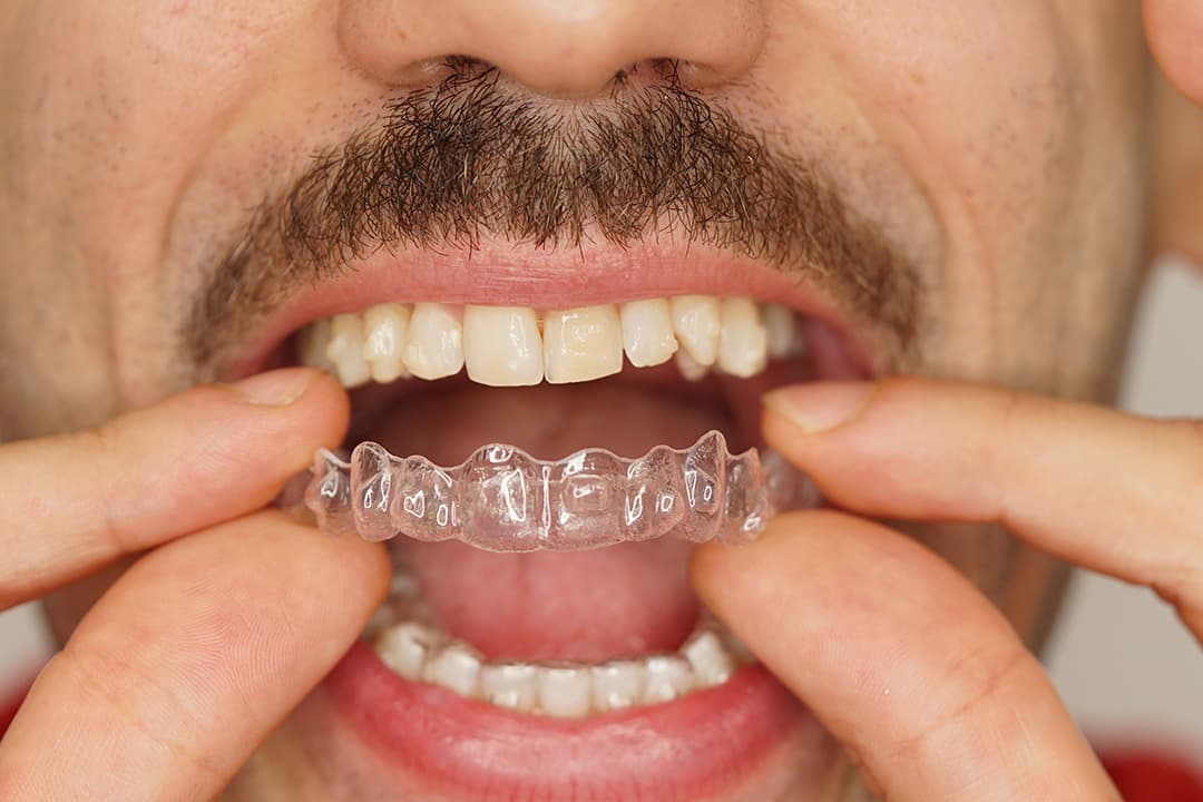 Ataches Invisalign: Qué son, cómo funcionan y su importancia